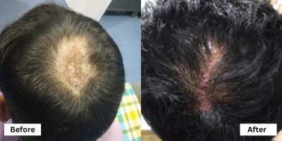 Nevus Sebaceous Removal Before And After