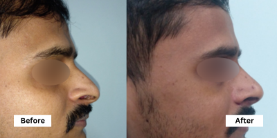 Rhinoplasty Surgery Procedure Images | Dr Yv Rao Clinics