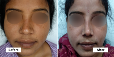 Rhinoplasty Surgery Procedure Images | Dr Yv Rao Clinics