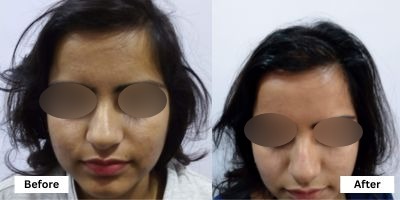 Hair Fall Treatment Images | Dr Yv Rao Clinics