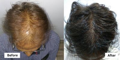 Hair Fall Treatment Images | Dr Yv Rao Clinics