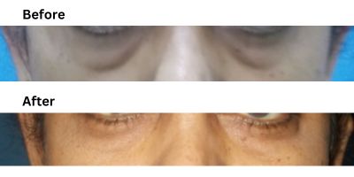 Under Eye Fat Transfer Procedure Images | Dr Yv Rao Clinics