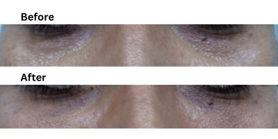 Under Eye Fat Transfer Procedure Images | Dr Yv Rao Clinics